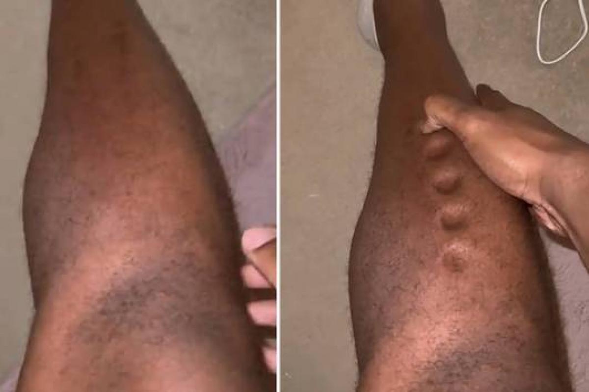 El "asqueroso" vídeo viral de un atleta olímpico: se le forman ...