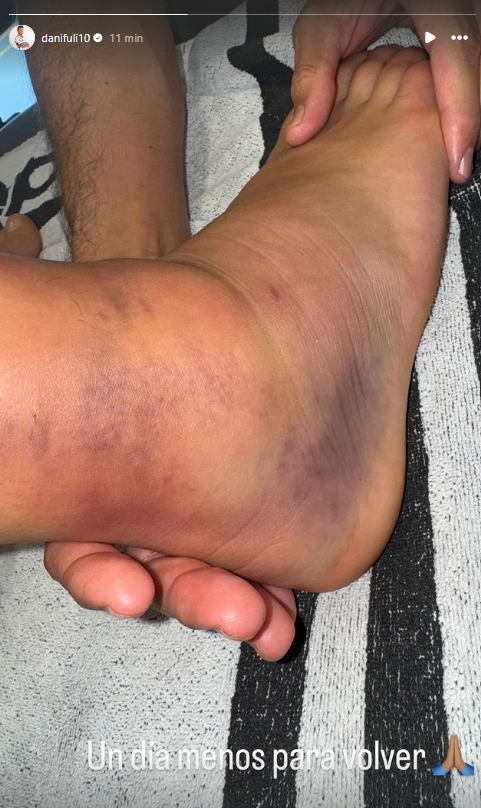 Ceballos enseña su dura lesión de tobillo