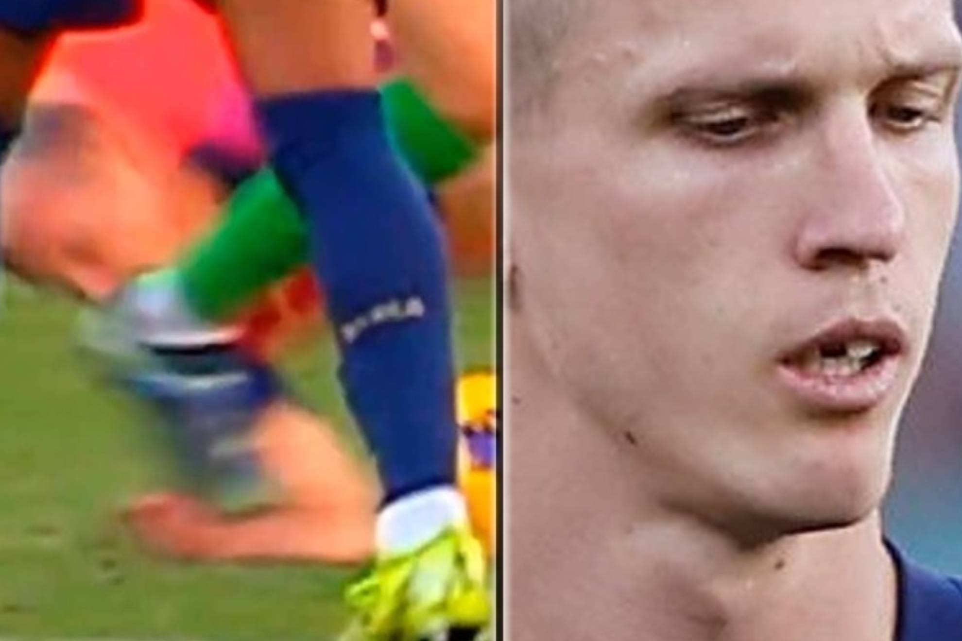 Dani Olmo y la búsqueda de su diente perdido en Sevilla: "¿Por qué lo ...