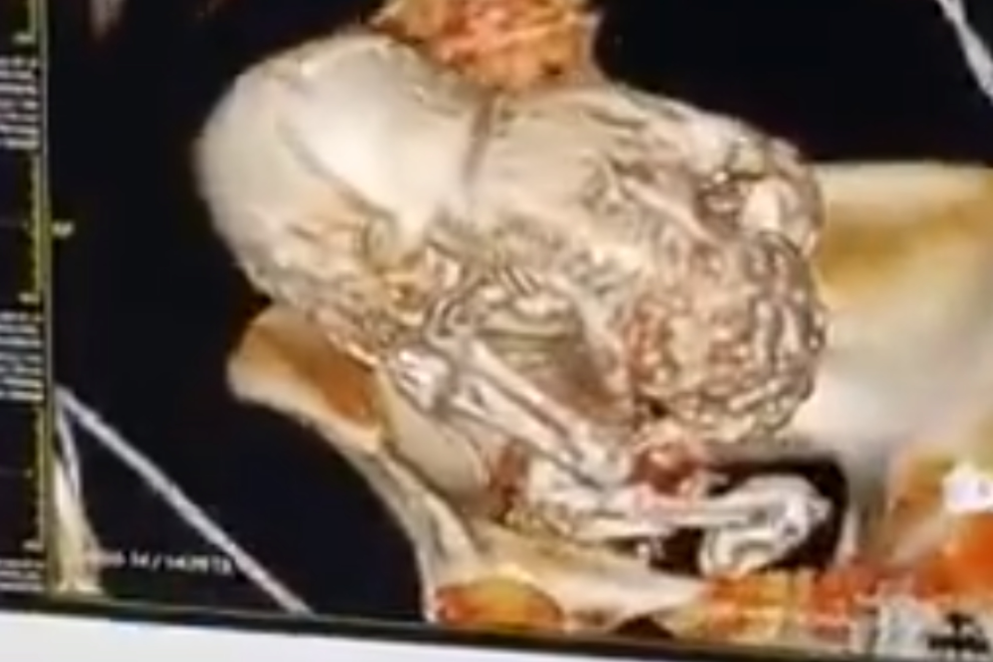 Una mujer va al médico por un cálculo, le encuentran un bebé ...