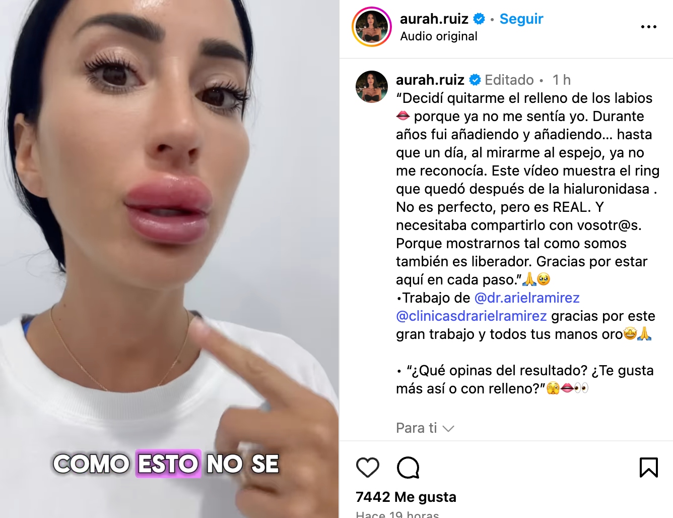 Aurah Ruiz confiesa su último retoque estético: "Me quité el relleno ...